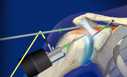 Shoulder Impingement Surgery | Omaha Shoulder Surgery