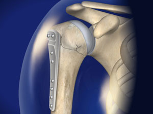orif surgery humerus fracture | Omaha Shoulder Surgery