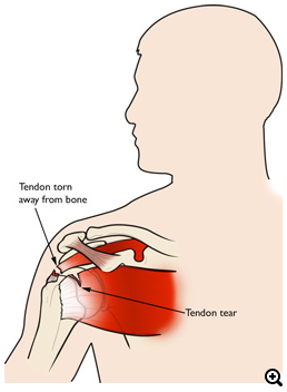 | Omaha Shoulder Surgery