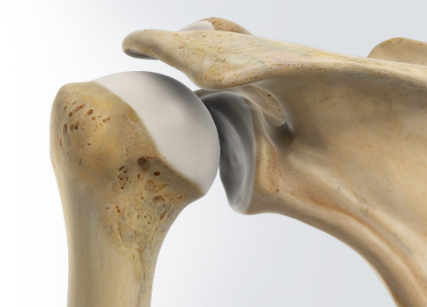Arthroscopic Bankart Repair | Omaha Shoulder