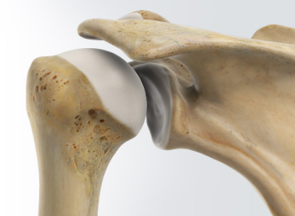 Omaha Shoulder Arthroscopy | Arthroscopic Capsular Plication