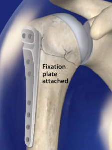 ORIF Surgery for Proximal Humerus Fracture | Omaha, Ne