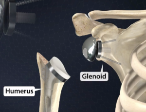 Shoulder Resurfacing Surgery | Omaha, Ne