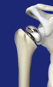 Total Shoulder Replacement | Omaha Shoulder Replacement